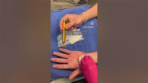 Have You Heard Of Palmar Hyperhidrosis Aka Excessive Palm Sweating 🤲💦 Youtube