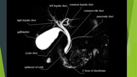 Mrcp Radiology