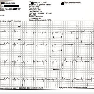 This EKG Documents Poor R Wave Progression As Indicated By The Download Scientific Diagram