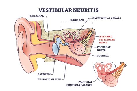 Vestibular Neuritis And Labyrinthitis Thcp