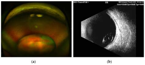 Management Of Spontaneous Crystalline Lens Luxation In A Patient