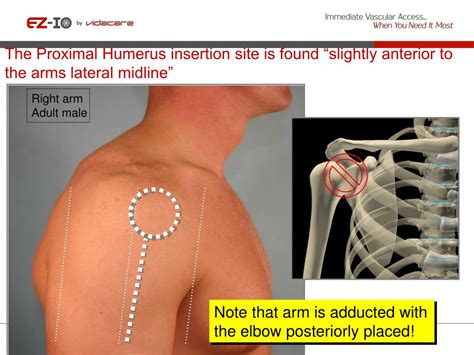Ppt Intraosseous Vascular Access Powerpoint Presentation Free
