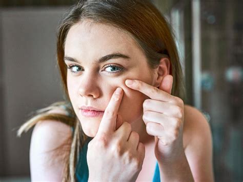 Azelainsäure Superstar Gegen Pickel