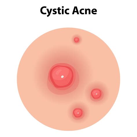 Cystic Acne Scars On Chest