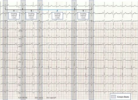 A Tale Of Two Parallel Rhythms Circulation
