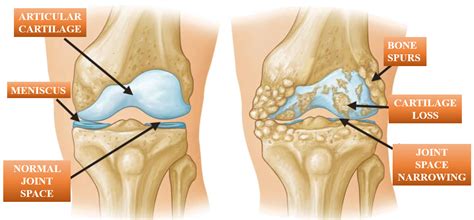 Understanding Osteoarthritis Causes Symptoms And Treatment Options