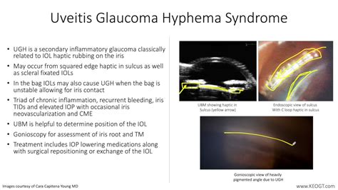 Uveitic Glaucoma