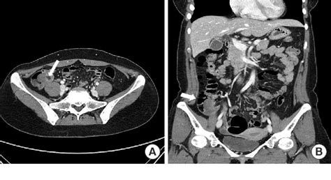 Figure 1 From Strangulated Appendiceal Intussusception Caused By Isolated Endometriosis