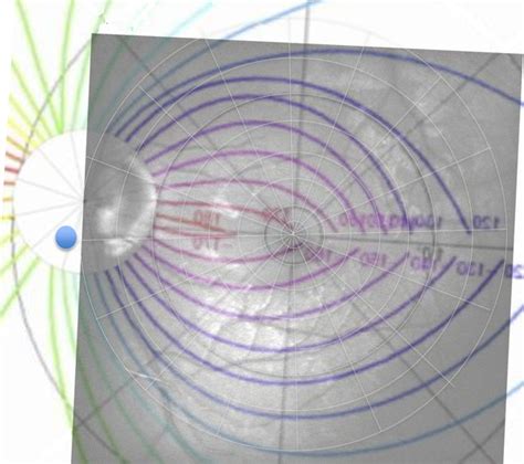 Nerve Fiber Course Model Jansonius Et Al With Superimposed Visual