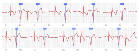 Ventricular Bigeminy