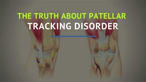 Patellar Tracking Disorder Artofit