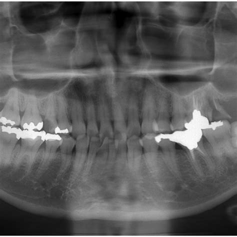 Pdf High Cervical Transmasseteric Anteroparotid Approach For