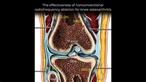 The Effectiveness Of Nonconventional Radiofrequency Ablation For Knee