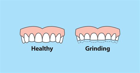 How To Fix Grinding Jaw At Salvador Kress Blog