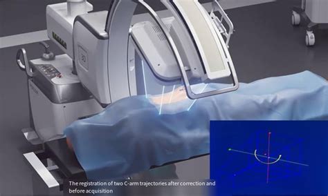 the core technology of orthopedic surgery robot positioning