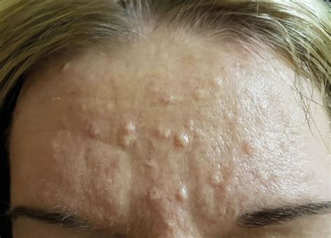 ¿cómo Quitar Verrugas Por Un Dermatólogo