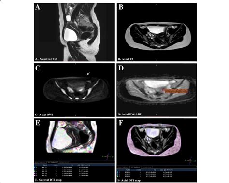 What Is A Normal Endometrial Thickness In Mm At Elizabeth Case Blog