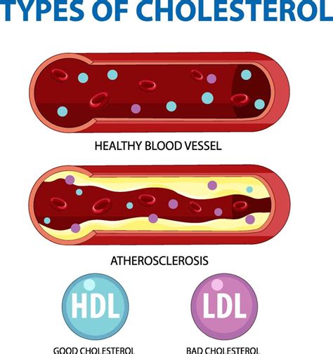 Types Of Cholesterol HDL And LDL Vector Art At Vecteezy