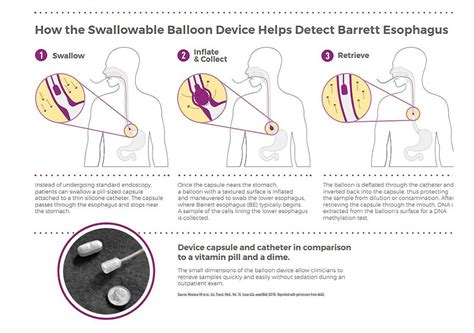 Prevention For Esophageal Cancer At Nicolas Brinson Blog