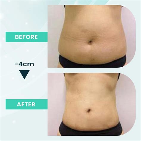 Weight Loss Before And After Singapore V Aesthetics Body Slim