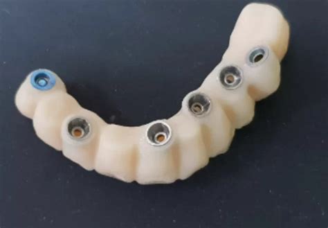 How To Choose The Right Multi Unit Abutments