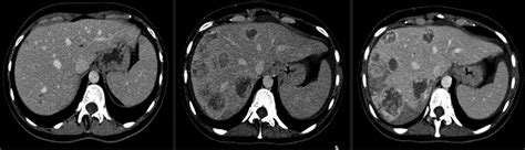 Choriocarcinoma Syndrome Development Axial Contrast Enhanced Ct
