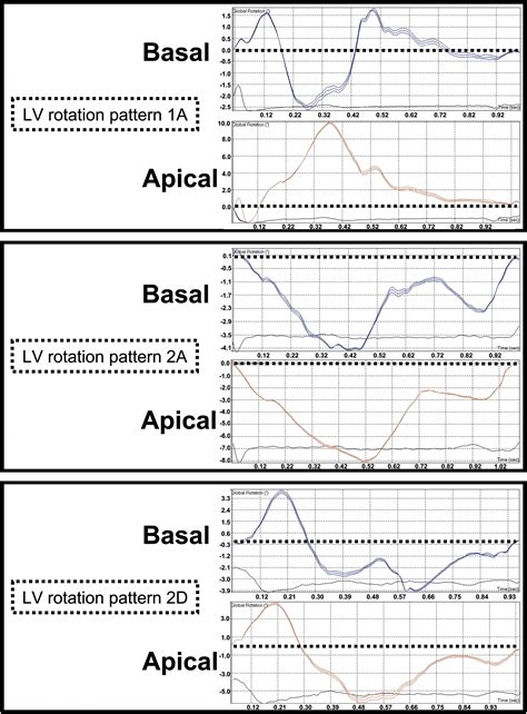 Diagnostic Value Of Rigid Body Rotation In Noncompaction Cardiomyopathy