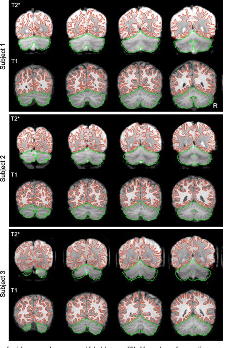 Functional Connectivity Magnetic Resonance Imaging Semantic Scholar