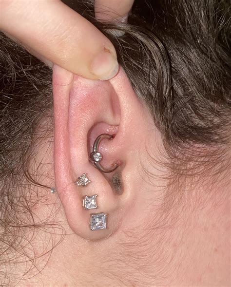 Help Hypertrophic Scarring Rpiercing