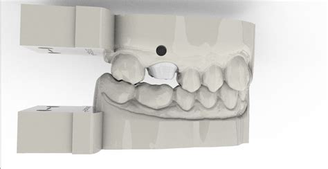 ⚕️ Digital Quadrant Model With Itero Articulator Interfaces・ Stl File For 3d Printing And Cnc