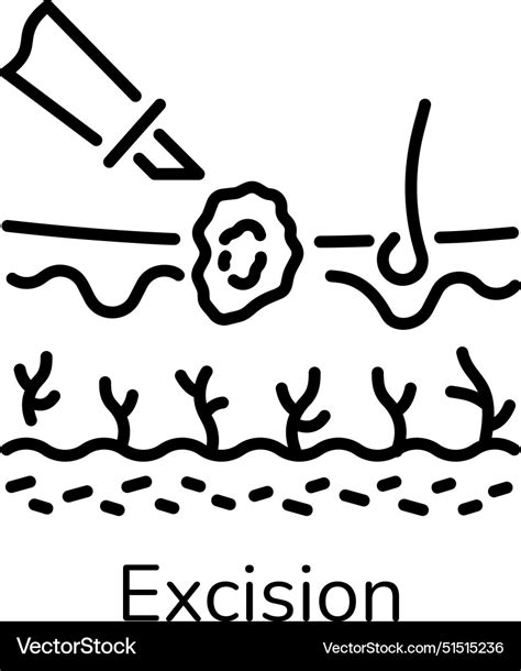 Excision Royalty Free Vector Image Vectorstock