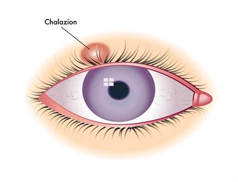 Chalazion Cause Durée Photo Traitement Enkysté Pharmacie De