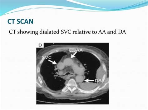 Chronic Constrictive Pericarditis Pptx