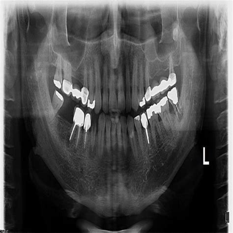 Teeth Object Detection Dataset V1 2024 06 06 10 08am By Abdo