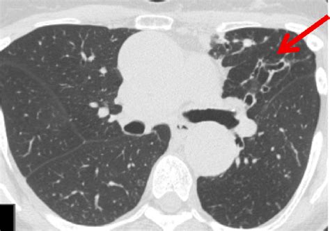 High Resolution Chest Computed Tomography Of Nodular Bronchiectasis