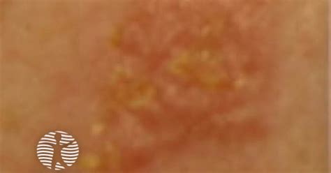 Positive Patch Test To Feverfew Image