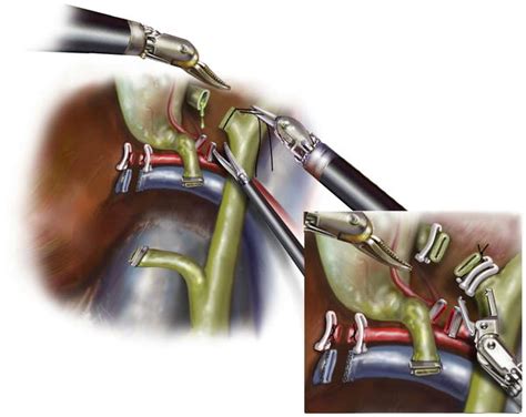 Robotic Hepatic Resections Segmentectomy Lobectomy Parenchymal Sparing Basicmedical Key