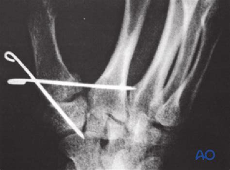 K Wire Fixation For Metacarpal Bennett Fracture