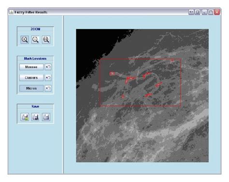 A Marked Cluster Of Microcalcifications Download Scientific Diagram