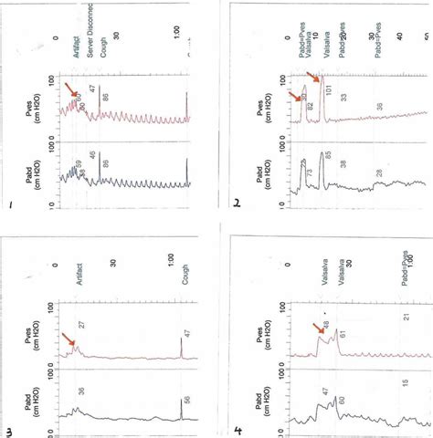 Characteristics Of Different Types Of Cough” Waveforms Download Scientific Diagram