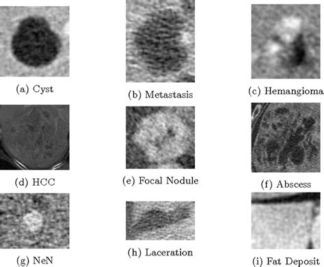Classification Of Hepatic Lesions Using The Matching Metric Paper And Code Catalyzex