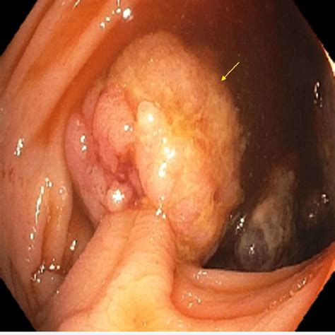 Colonoscopy Image Shows A 20 Mm Polyp Arrow At The Hepatic Flexure Download Scientific Diagram