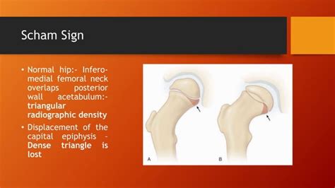 Slipped Capital Femoral Epiphysis Ppt