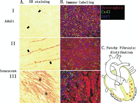 Pattern And Distribution Of Interstitial And Replacement Fibrosis Of