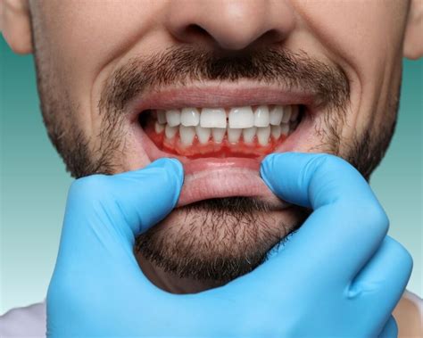Gum Disease Treatment In Turkey Gum Surgery Soraca Med