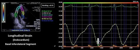 Apical 3 Chamber View Left And Longitudinal Strain Time Curve Of The