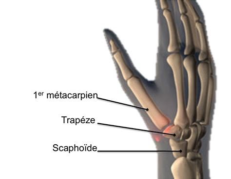 Rhizarthrose Ou Arthrose Du Pouce Groupe Clinique Drouot