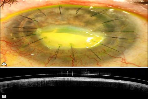 Acute Calcific Band Keratopathy As An Adverse Effect Of Reco Cornea