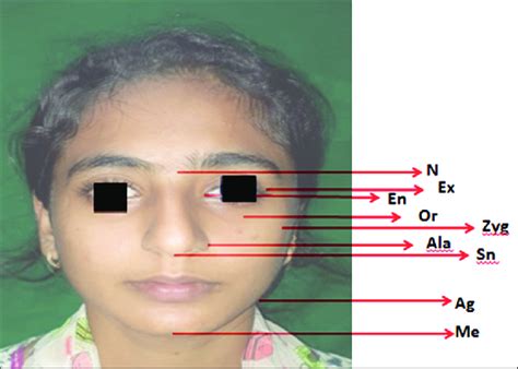 Soft Tissue Landmarks On Photograph Download Scientific Diagram