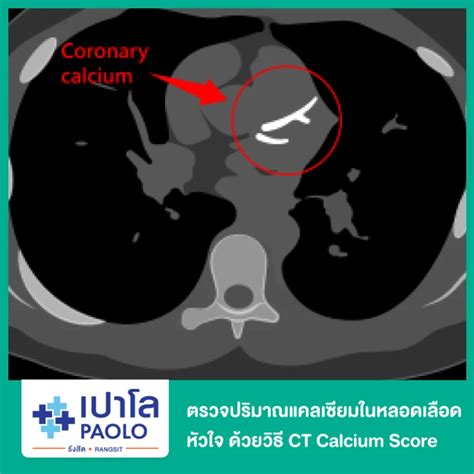 ตรวจปริมาณแคลเซียมในหลอดเลือดหัวใจ ด้วยวิธี Ct Calcium Score ที่
